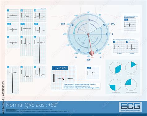 When The Frontal Qrs Axis Is At 80° The Qrs Amplitude Of Lead Avf Is