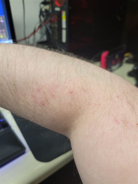 My Arm Has Been Itching For A Month Havent Been Around Poison Ivy Or