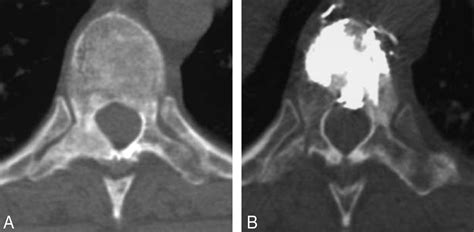 Osteoblastic Metastases Osteoblastic Response In Patients With
