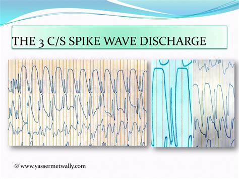 Issues In Brainmapping The Secrets Of Conventional Eeg Pptx Brain And Nervous System