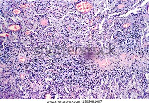 Tuberculosis Histology