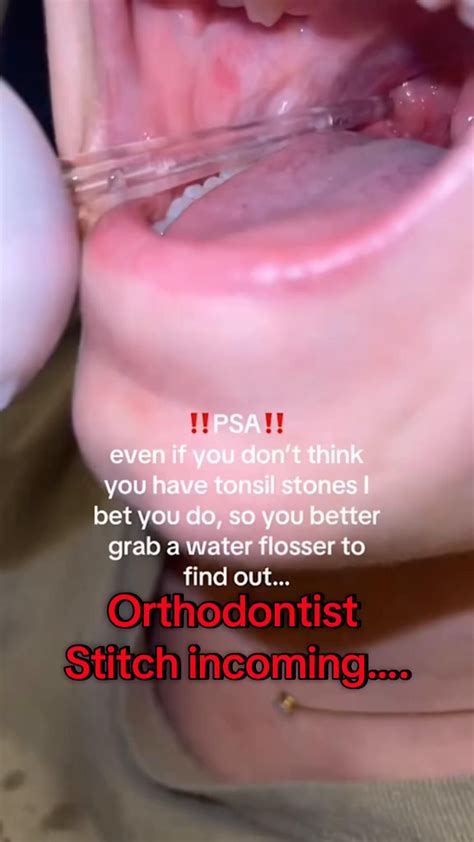 Tonsil Stones Are No Fun Tonsilstones Artofit