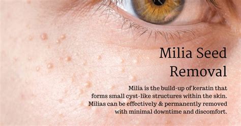 Milia Removal Malaysia Effective Professional And Best Price