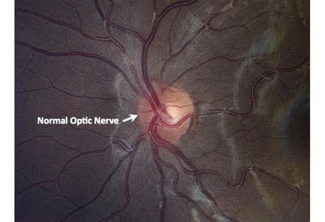 Normal Optic Nerve