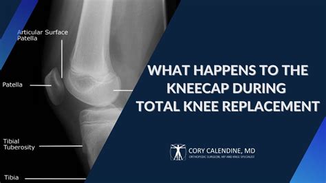 What Happens To The Kneecap During Total Knee Replacement Youtube