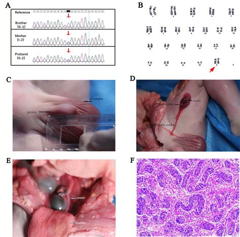 Frontiers 46xx Testicular Disorders Of Sex Development With Dmd Gene