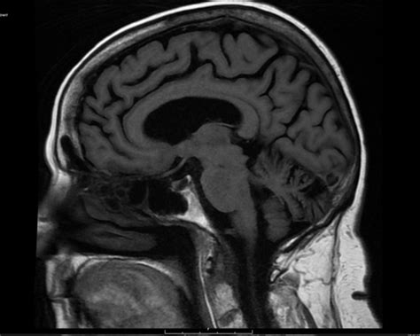 Mri Brain Without Contrast Greater Waterbury Imaging Center