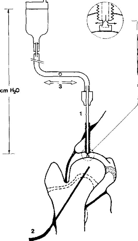 Structure Of Intracapsular Ligament Semantic Scholar