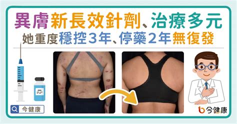 感冒好了卻還一直咳嗽？醫指常見原因，4招有助改善！ 今健康