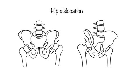 Hip Dislocation Vector Images 28
