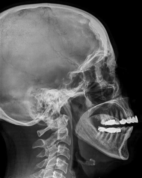 Hyperostosis Frontalis Interna Pacs