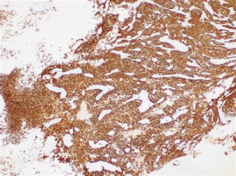 Immunoperoxidase Staining Positive For Melan A In 40× Magnification