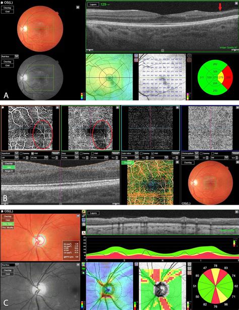 Oct Imaging Findings From Ss Patient Performed Several Months After