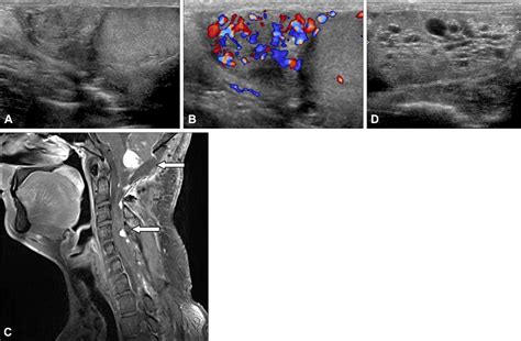 Gamut Of Extratesticular Scrotal Masses Anatomic Approach To