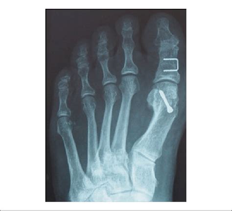 Radiography Shows A Solid Fusion 34 Months After Pip Arthrodesis Of The Download Scientific