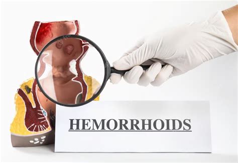 Understanding Piles Hemorrhoids Causes Symptoms Diagnosis And