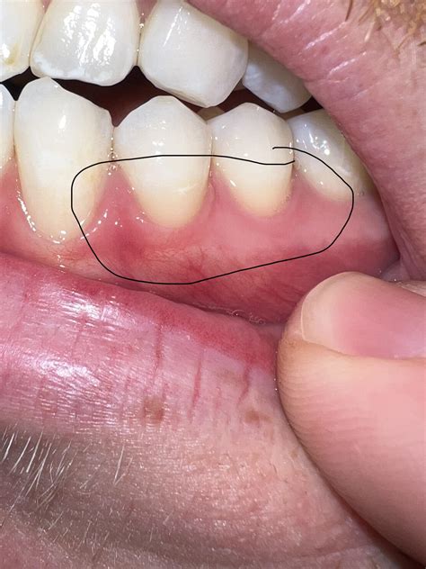 Does This Look Like Gingivitis R Askdentists