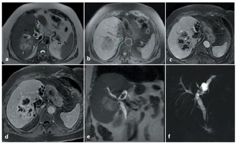 Cholangitis Radiology Key