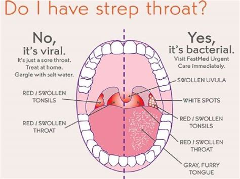 Sore Throat No Tonsils