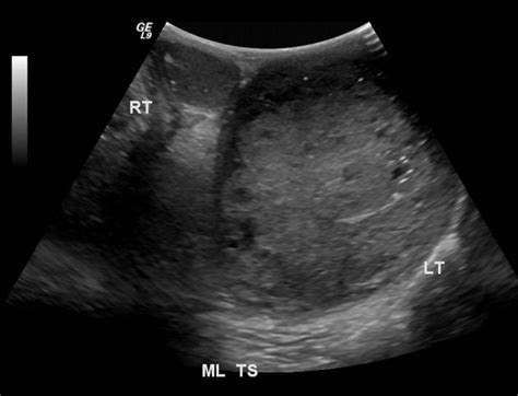 Choriocarcinoma Ultrasound