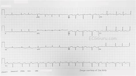 Supraventricular Tachycardia With Wenckebach Conduction Ecg Guru
