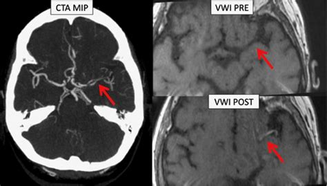 Left Cta Maximum Intensity Projection Mip Image Annotated