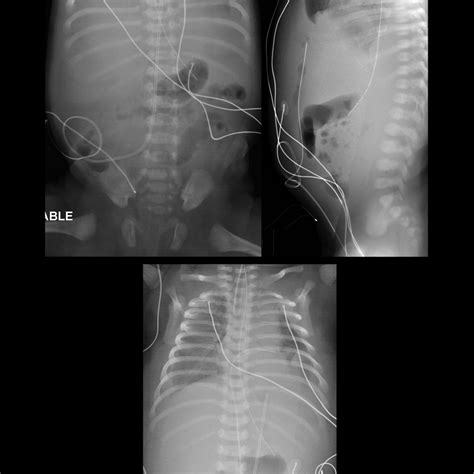 Premature Newborn After Umbilical Venous Catheter Placement Pediatric Radiology Case