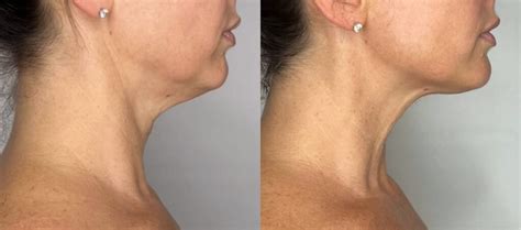 Sofwave Vs Ultherapy Or Thermage Flx For Skin Tightening Dr Michele