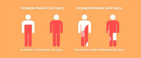 Classification Of Spinal Cord Injuries Naveen Spine Classification Of Spinal Cord Injuries Naveen Spine