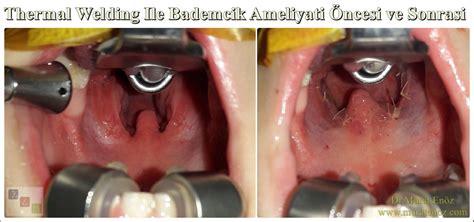 Tonsillectomy And Adenoidectomy Post Op