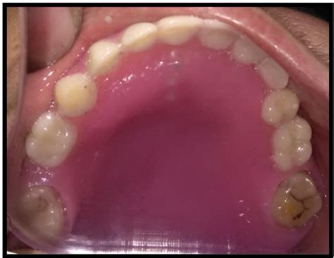 Figure 7 From Cu Sil Denture An Innovative Approach To Preserve The Few Remaining Natural Teeth