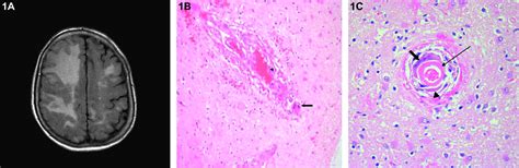 Cerebral Amyloid Angiopathy Related Inflammation Three Case Reports