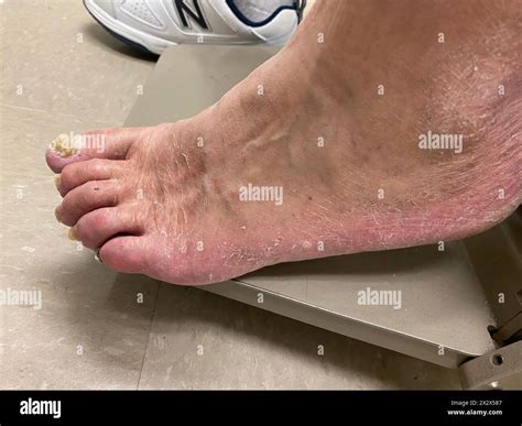 Athletes Foot In A 65 Year Old White Male Patient Athletes Foot Or