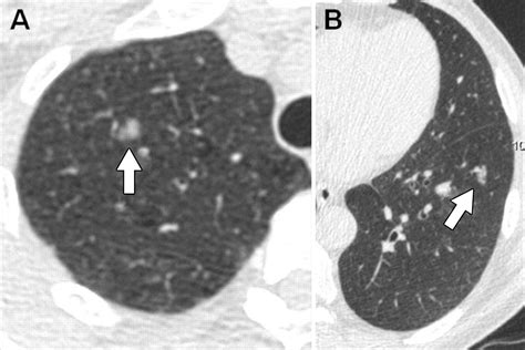 Differentiating Between Subsolid And Solid Pulmonary Nodules At Ct Inter And Intraobserver
