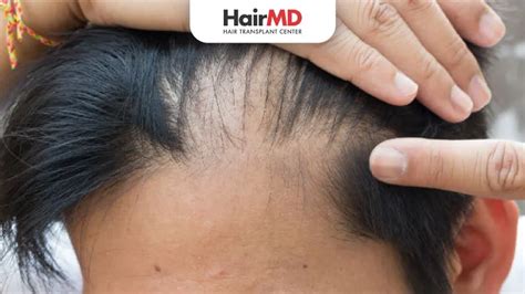 Itchy Scalp And Hair Loss Causes Treatments And Prevention