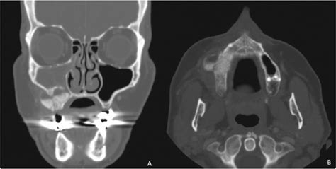 Sinonasal Complications Following The Sinus Lift Procedure Ochsner