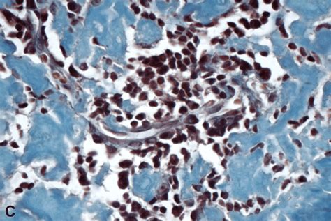 Patient I M Ligneous Conjunctivitis A D Areas Containing Download Scientific Diagram