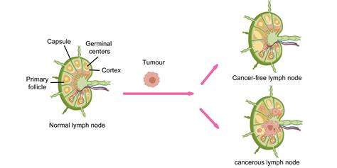 venn bctype lymphnode
