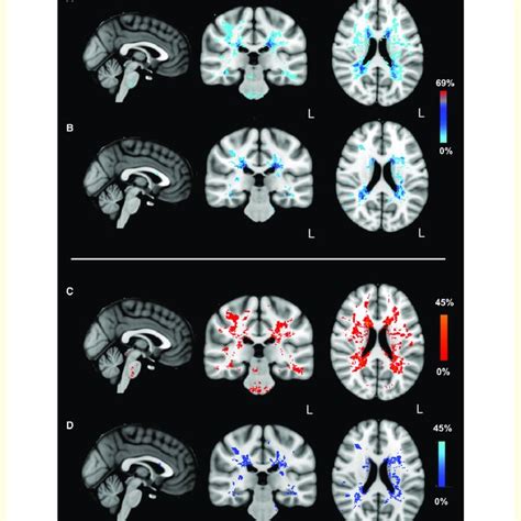 Mapping Of Multiple Sclerosis Lesion Distribution Multiple Sclerosis Download Scientific
