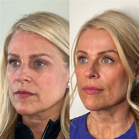 Sculptra And Filler Mobo Med Spa