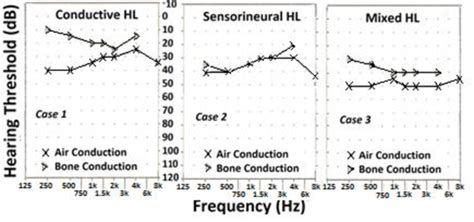 Variation Of Hearing Threshold With The Frequency For Three Main