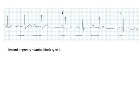 Ecg Lecture Sinus Arrest Sinoatrial Exit Block Av Block And Escape…