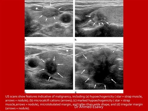 Tirads Thyroid Nodule Imaging Reporting And Data System Dr Ahmed