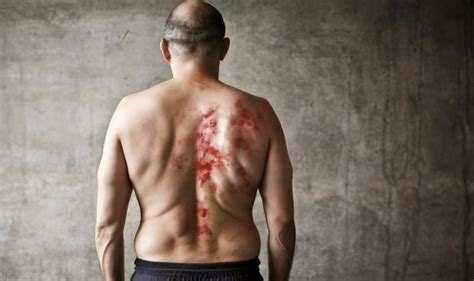 Sarcoma Síntomas Tratamiento Y Causa