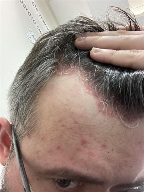 Scalp Psoriasis Update More In Comments Rpsoriasis
