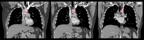 Ebus Staging Key Anatomic Landmarks