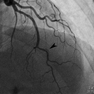 Spontaneous Dissection Of The Mid Portion Of The Left Anterior Download Scientific Diagram
