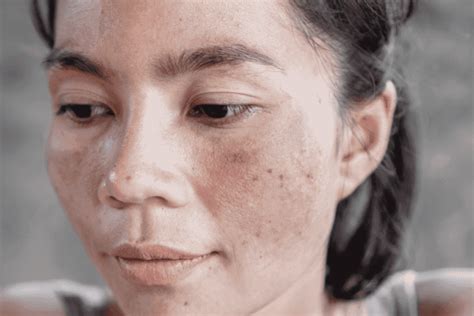 The Science Behind Chemical Peels For Hyperpigmentation Treatment