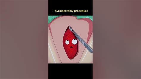Thyroidectomy Procedure Youtube