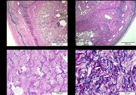Figure 2 From Chronic Pleuropulmonary Fibrosis And Elastosis Of Aged
